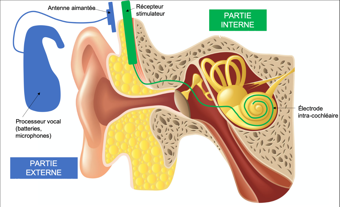 Trucs MAIS PAS Astuce: L’implant cochléaire - La Solution Auditive
